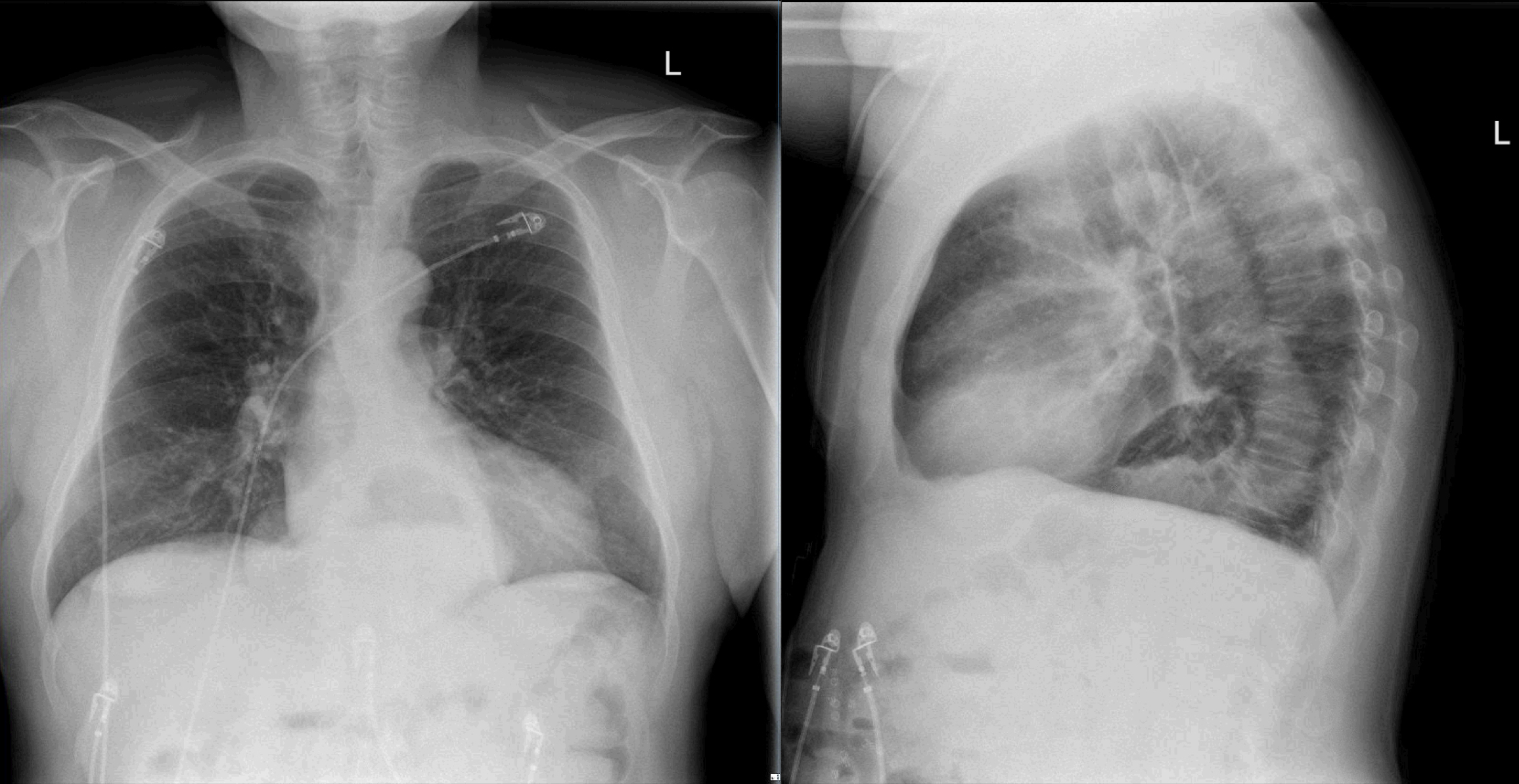 Incidental Hiatal Hernia On Chest X ray JETem Incidental Hiatal Hernia On Chest X ray JETem