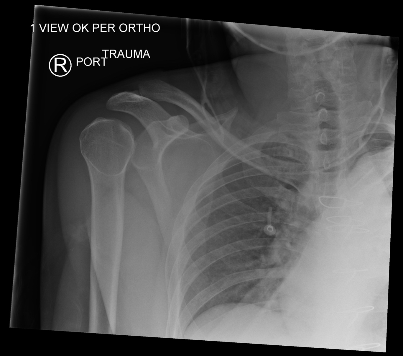 Shoulder Dislocation Lightbulb Sign Chest X ray And Post Reduction Shoulder Dislocation Lightbulb Sign Chest X ray And Post Reduction