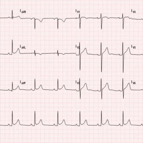 Acute Pericarditis: Electrocardiogram - JETem