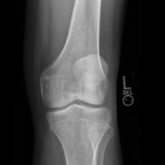 Normal Knee X-Ray: 3 View - JETem