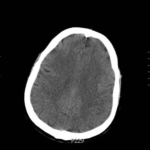 Normal Head CT - JETem
