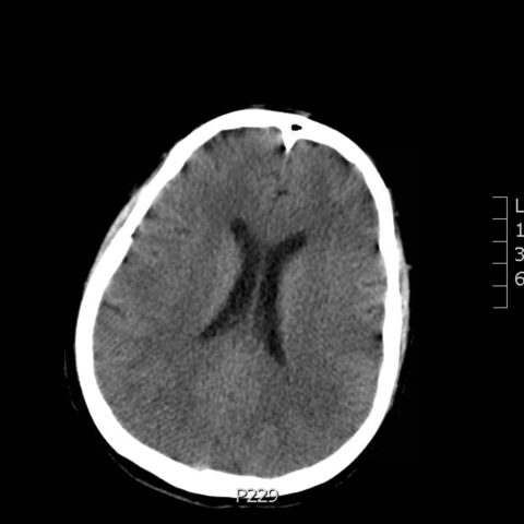Normal Head CT - JETem