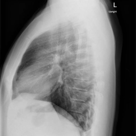 Normal CXR: AP and Lateral - JETem