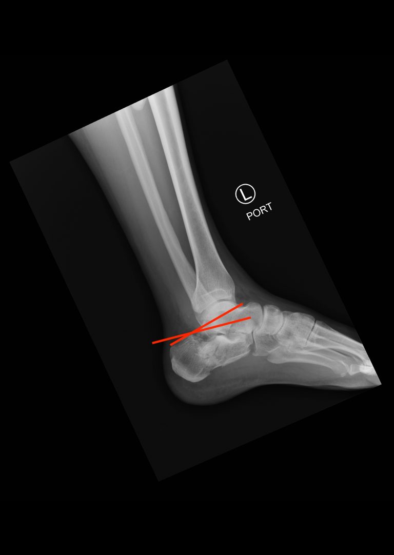 Left Calcaneal Fracture, XR, Annotated, Bohler's Angle, no numbers ...