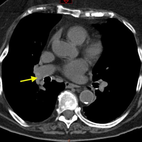 Pulmonary Embolism: Diagnosis by Computerized Tomography without ...