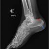 Calcaneal Fractures and Böhler’s Angle - JETem