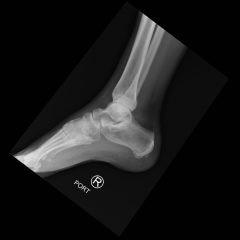 Calcaneal Fractures and Böhler’s Angle - JETem