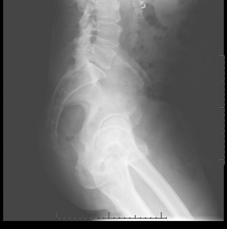 Bowel Perforation complicating an incarcerated inguinal hernia - JETem