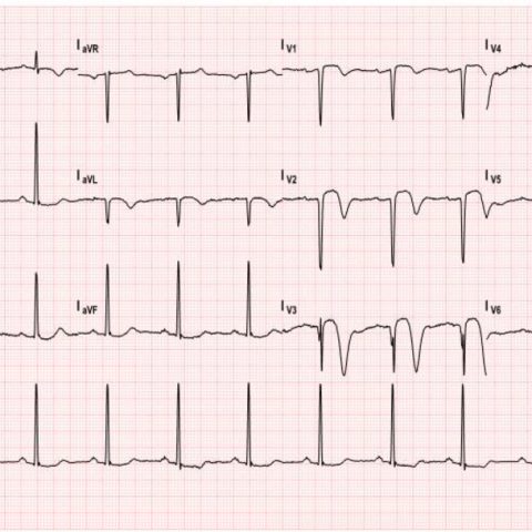 Acute Subdural Hematoma - JETem