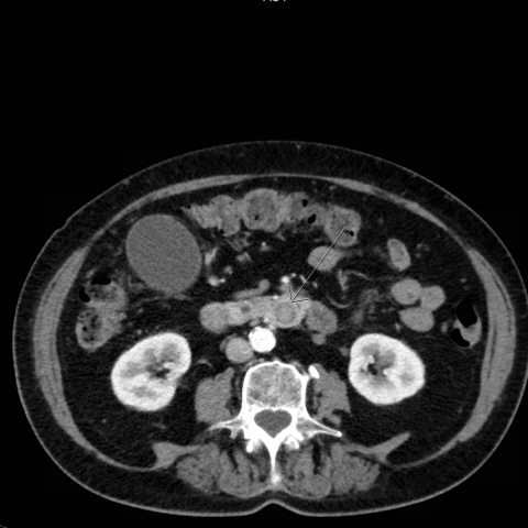 Choledocholithiasis - JETem
