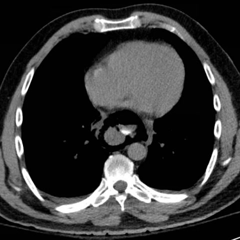 Globe Rupture - JETem