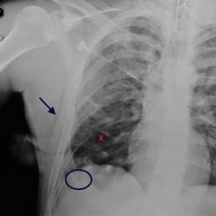 Open Pneumothorax - JETem
