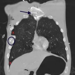 Open Pneumothorax - JETem