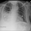 Re-expansion Pulmonary Edema - JETem
