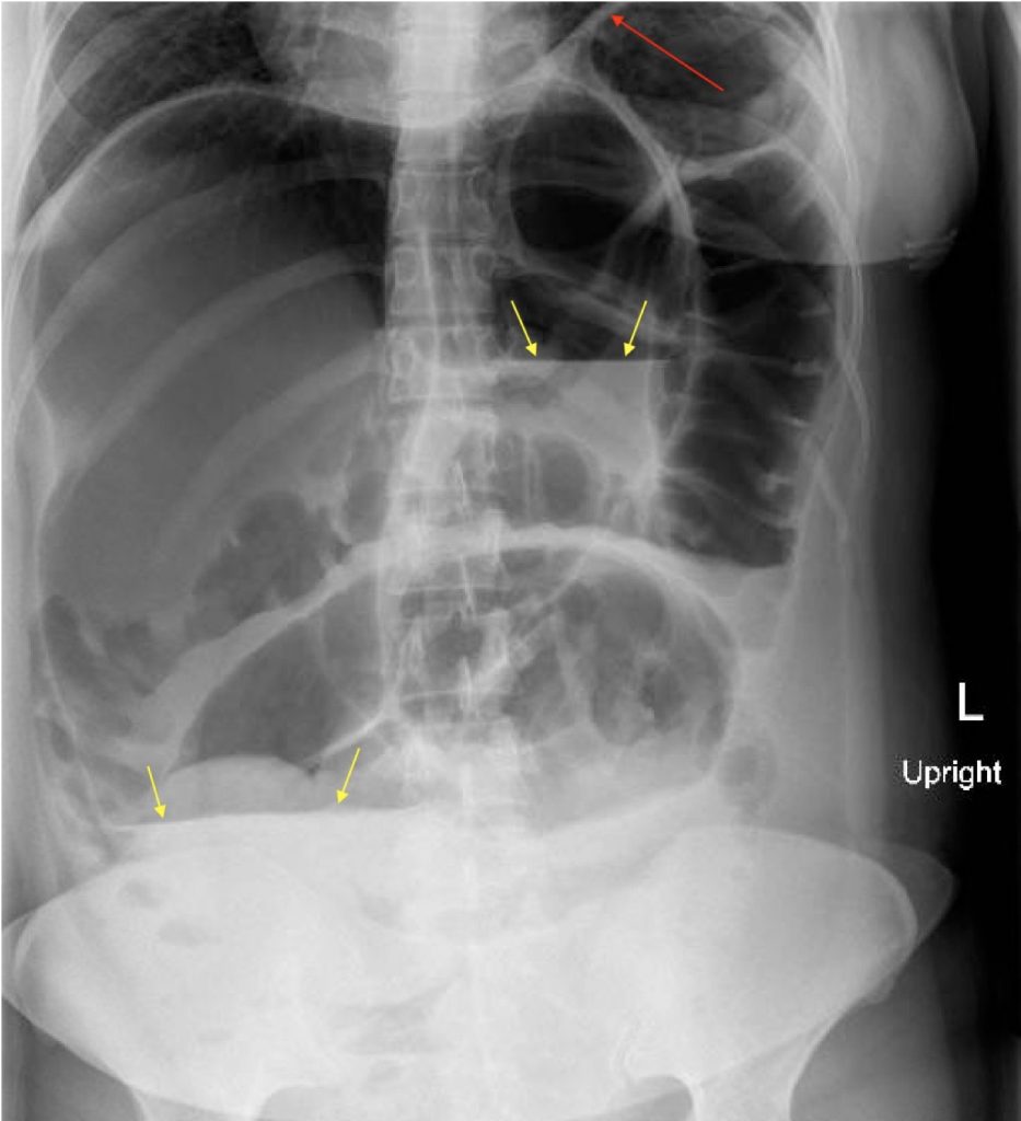 Volvulus, XR AP 1, Annotated. JETem 2017 - JETem