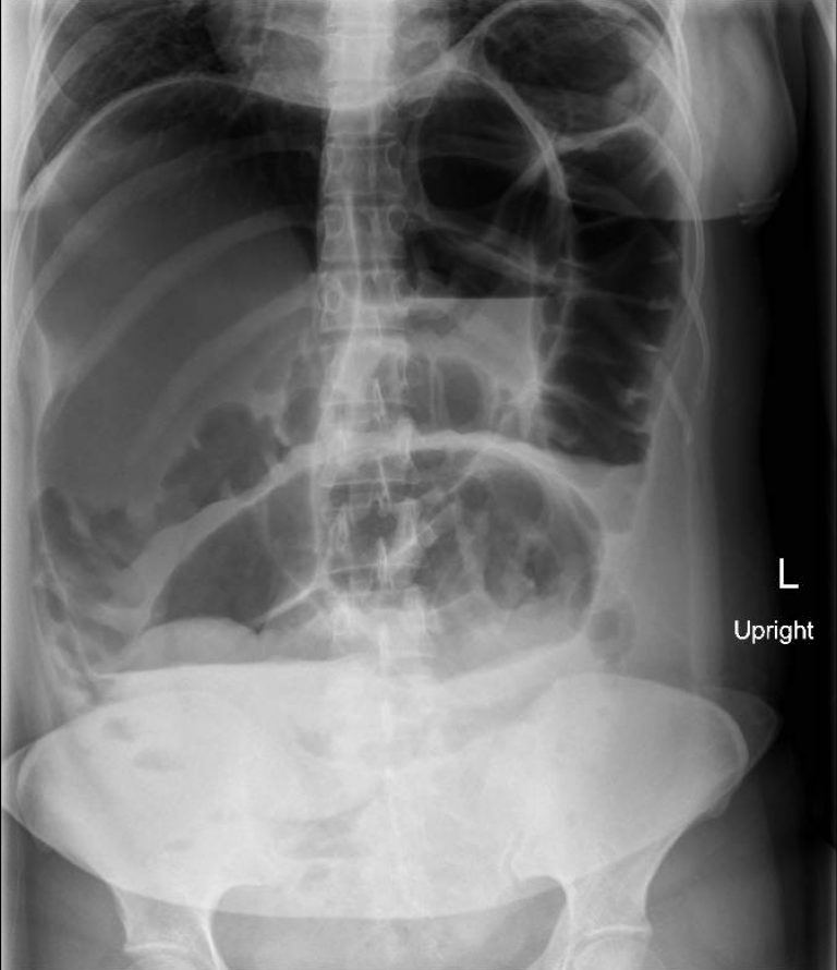 Volvulus, XR AP 1. JETem 2017 - JETem