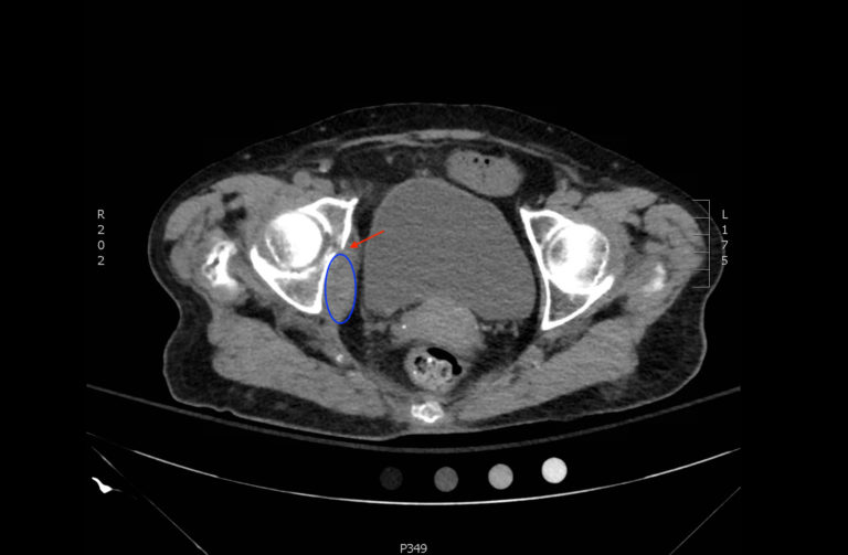 Acetabular Fracture, CT 1, Annotated. JETem 2017 - JETem