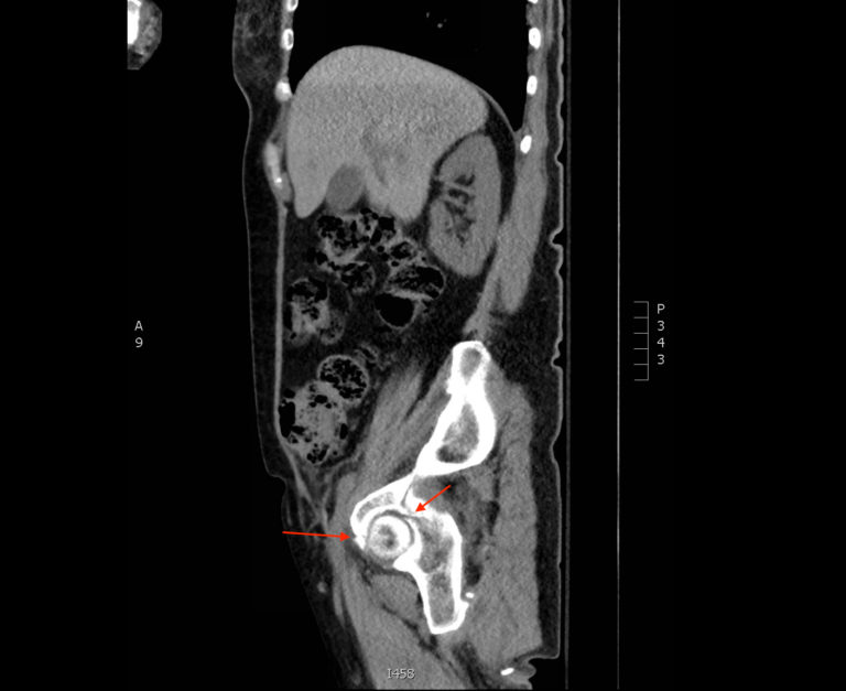 Acetabular Fracture, Sagital CT 2, Annotated - JETem