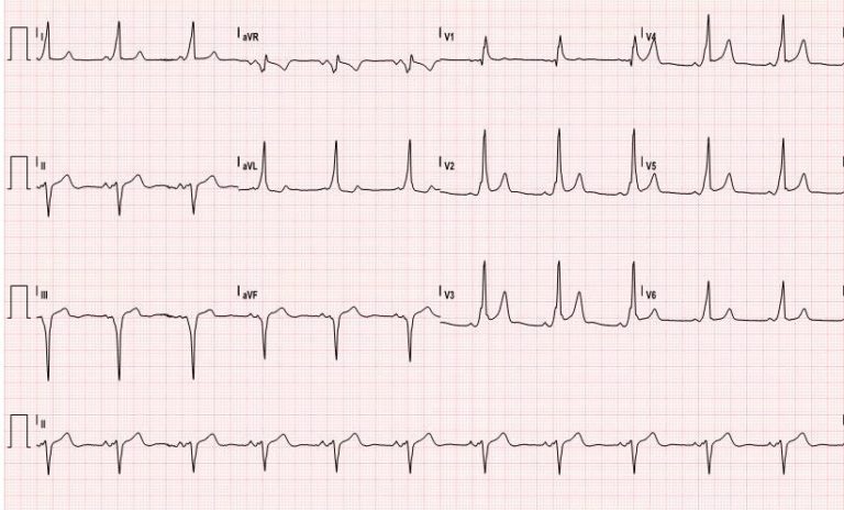 ECG 4-Normal Sinus with WPW - JETem