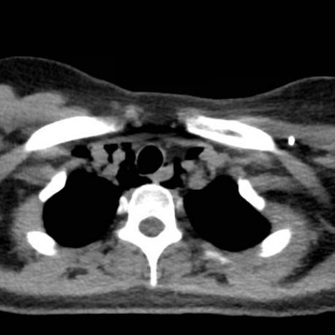 Spontaneous Pneumomediastinum: Hamman Syndrome - JETem