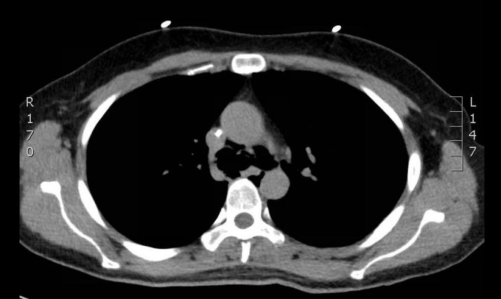 Hamman's Syndrome, CT axial 2. JETem 2018 - JETem