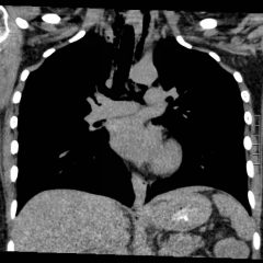 Spontaneous Pneumomediastinum: Hamman Syndrome - JETem