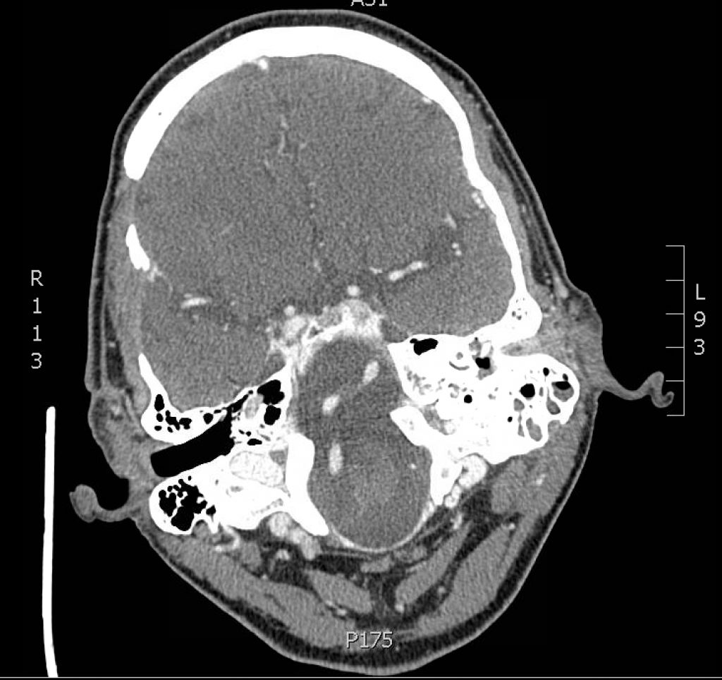 Left Mastoiditis, Axial CT 2. JETem 2018 - JETem