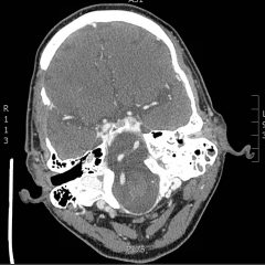 A Case of Otomastoiditis - JETem