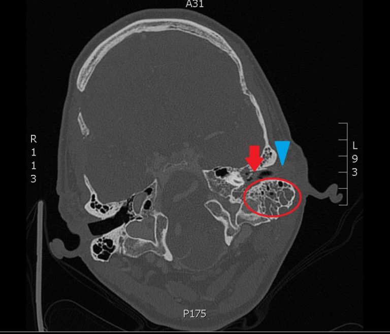 Left Mastoiditis, Axial CT, Annotated. JETem 2018 - JETem