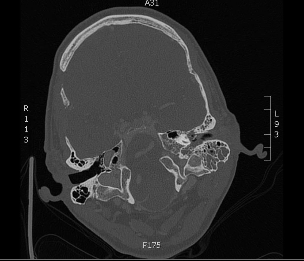 Left Mastoiditis, Axial CT. JETem 2018 - JETem
