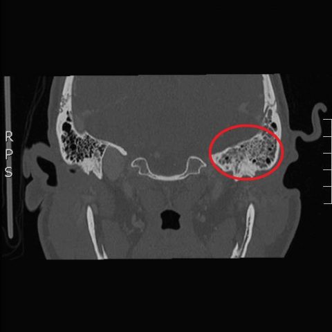 A Case of Otomastoiditis - JETem