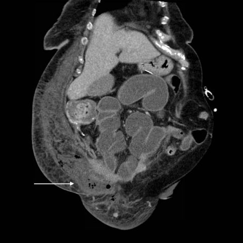 Necrotizing Soft Tissue Infection - JETem