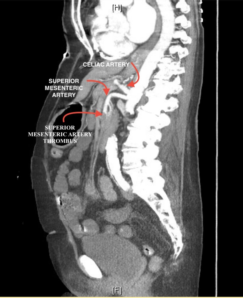 Superior Mesenteric Artery, Sagittal CT, Annotated. JETem 2018 - JETem