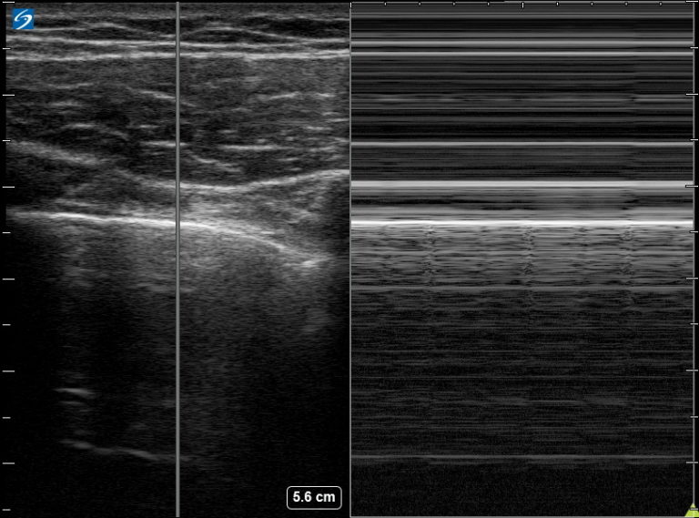 Abnormal Lung Sliding, M Mode Ultrasound. JETem 2018 - JETem