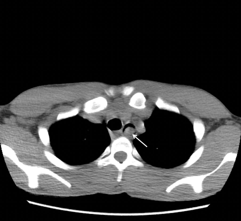 Impacted Food Bolus, Axial CT, Annotated. JETem 2018 - JETem