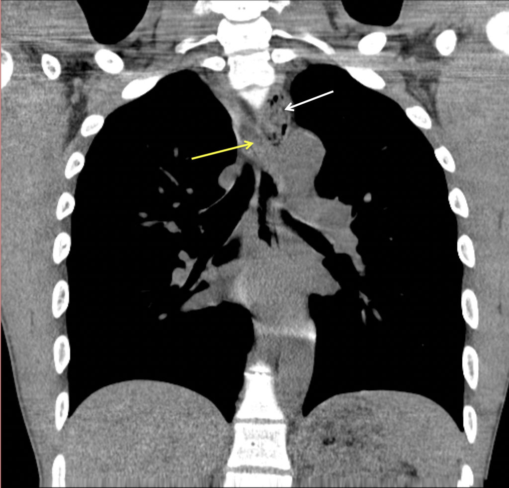 Impacted Food Bolus, Coronal CT, Annotated. JETem 2018 - JETem