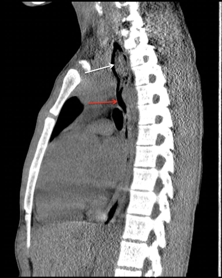 Impacted Food Bolus, Sagittal CT, Annotated. JETem 2018 - JETem