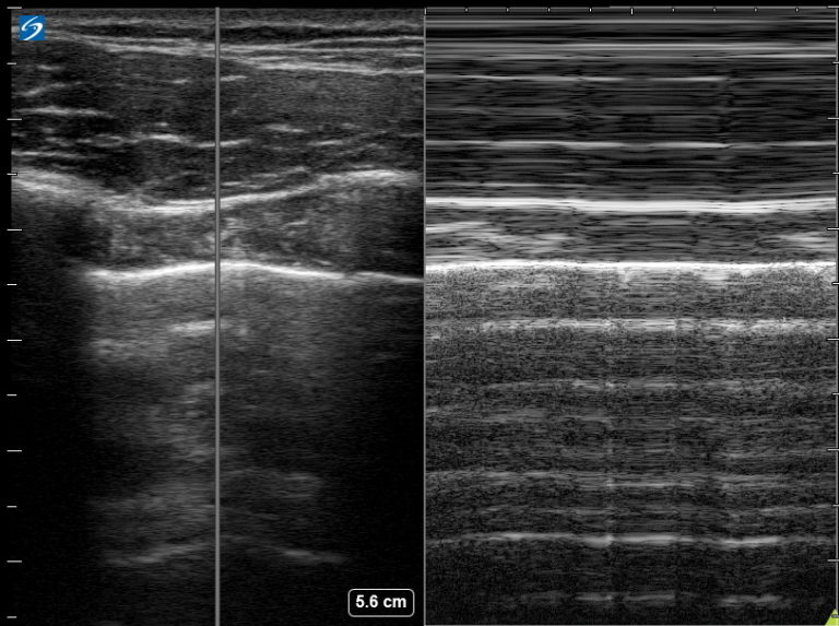 Normal Lung Sliding, M Mode Ultrasound. JETem 2018 - JETem