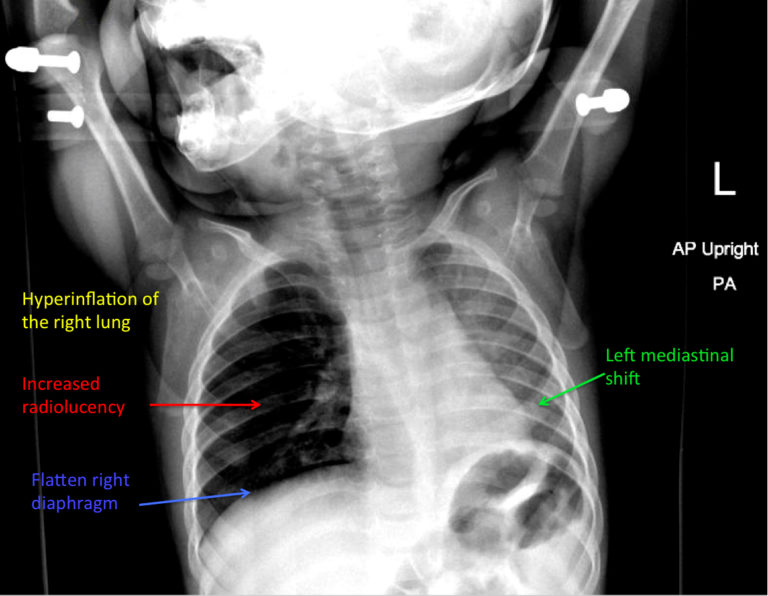 Pediatric Foreign Body Aspiration - JETem