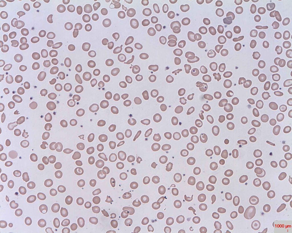 Peripheral Smear - JETem