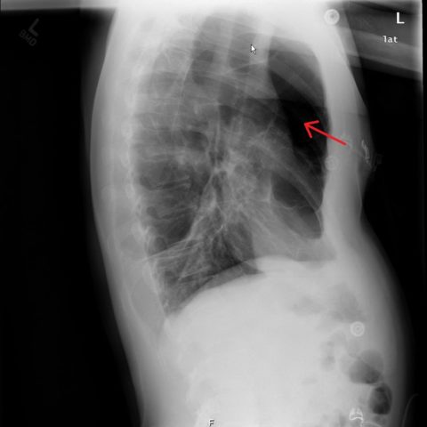 The Role of Chest X-Ray and Bedside Ultrasound in Diagnosing Pulmonary ...