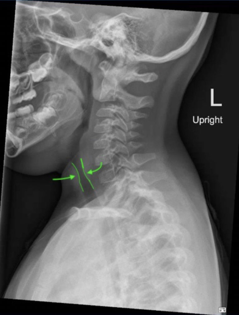 Croup. Lateral XR, annotated. JETem 2018 - JETem