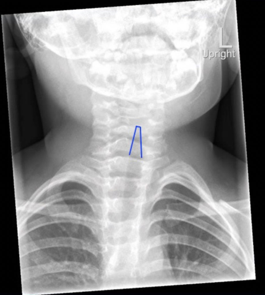 Croup. XR, annotated. JETem 2018 - JETem