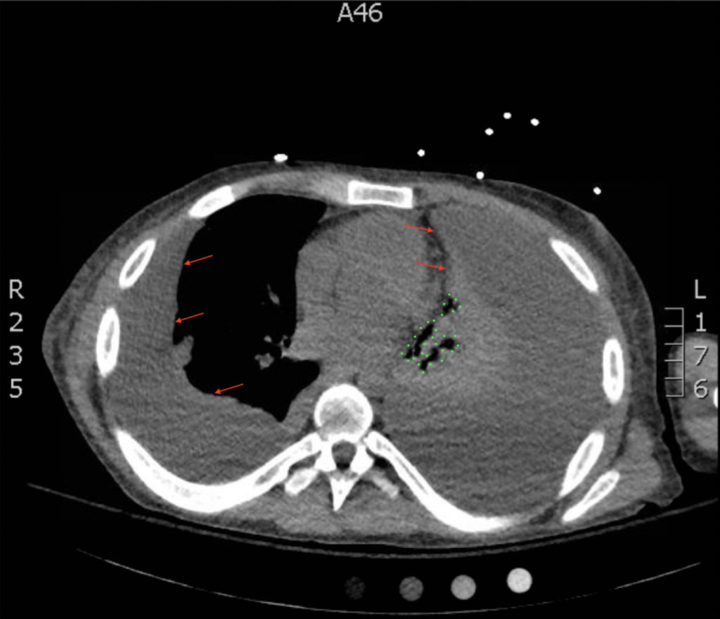 Endocarditis. CT, Annotated Still. JETem 2018 - JETem