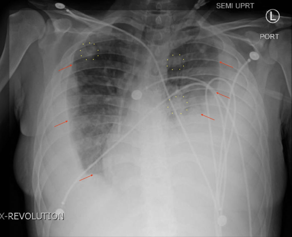 Endocarditis. CXR, Annotated. JETem 2018 - JETem