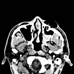 Facial Fracture Induced Periorbital Emphysema - JETem