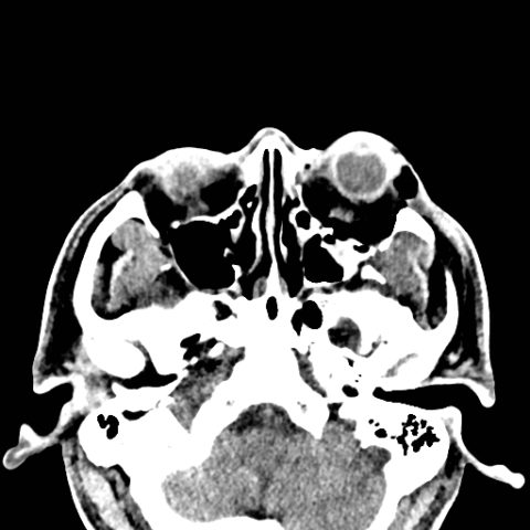 Facial Fracture Induced Periorbital Emphysema. Axial CT 3. JETem 2018 ...