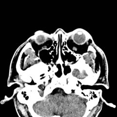 Facial Fracture Induced Periorbital Emphysema - JETem