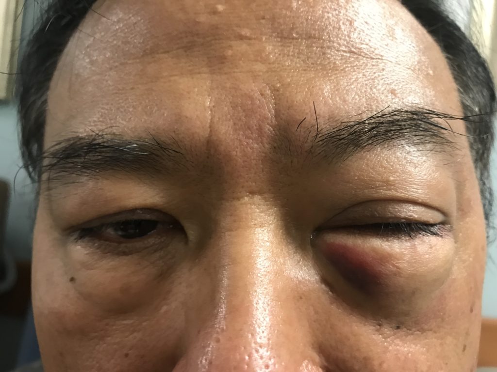 Facial Fracture Induced Periorbital Emphysema. Face Both Sides - JETem