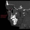 Facial Fracture Induced Periorbital Emphysema - JETem